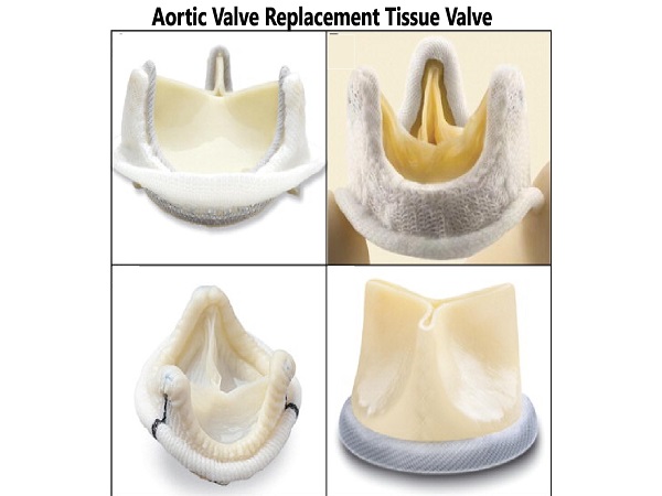 Aortic Valve Replacement Tissue Valve - Baberahma