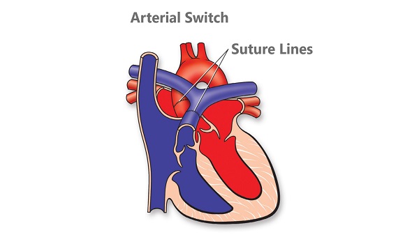 Arterial Switch Surgery - Baberahma